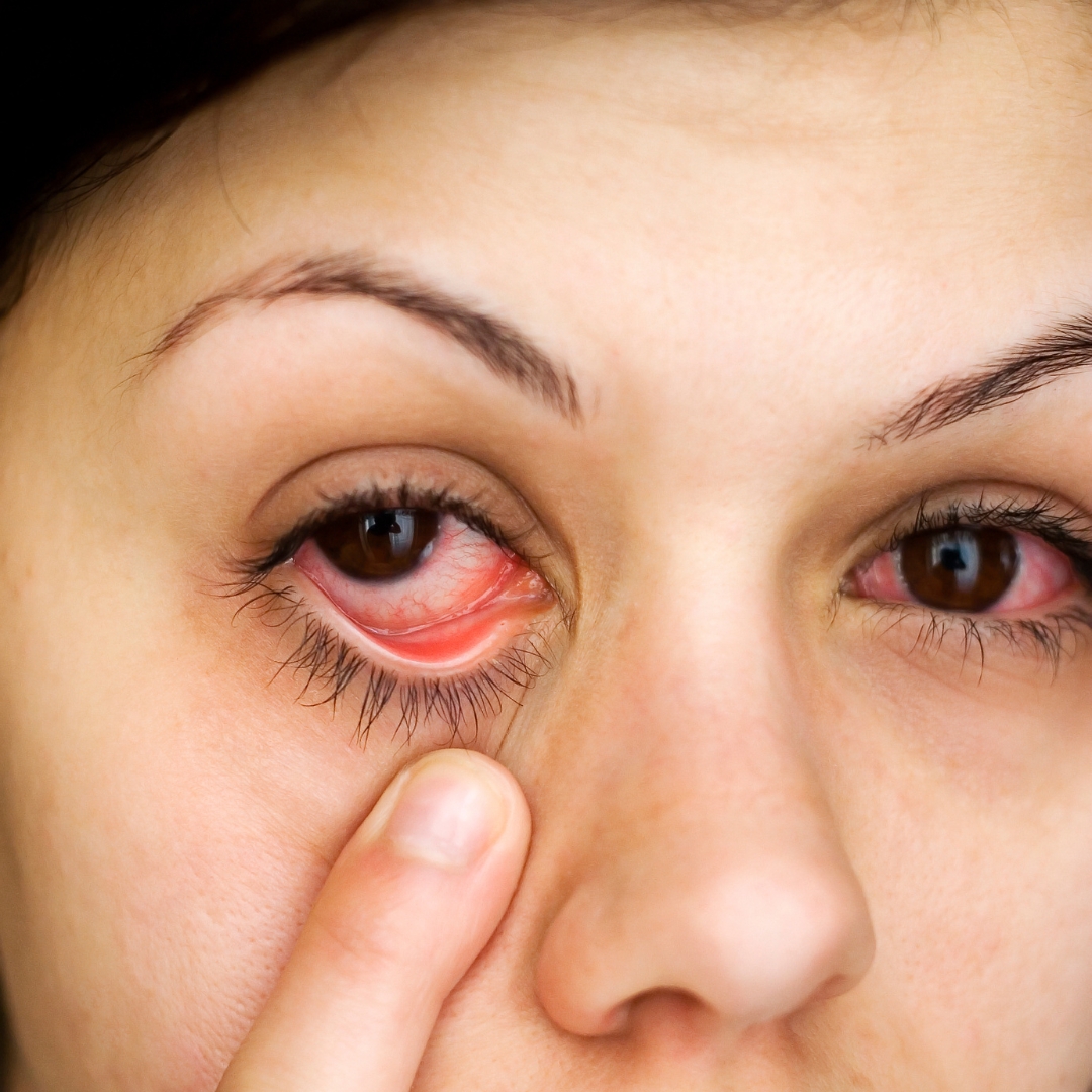 Eye Heal Original – Penawar Mata Mujarab